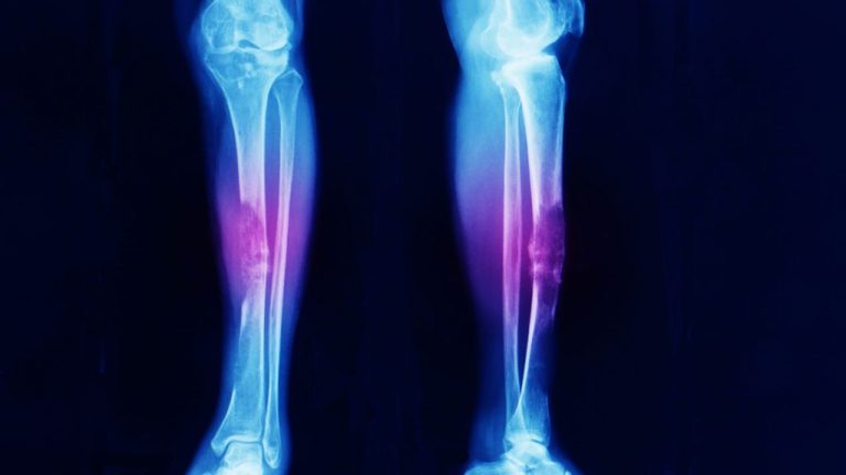 Sarcoma Cancer: Symptoms, Causes and Treatment