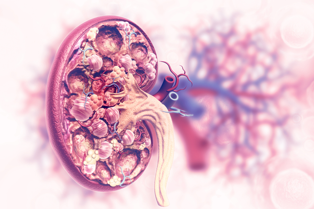 How Effective is Ayurveda in Helping Cure Kidney Cancer? - Pavtan